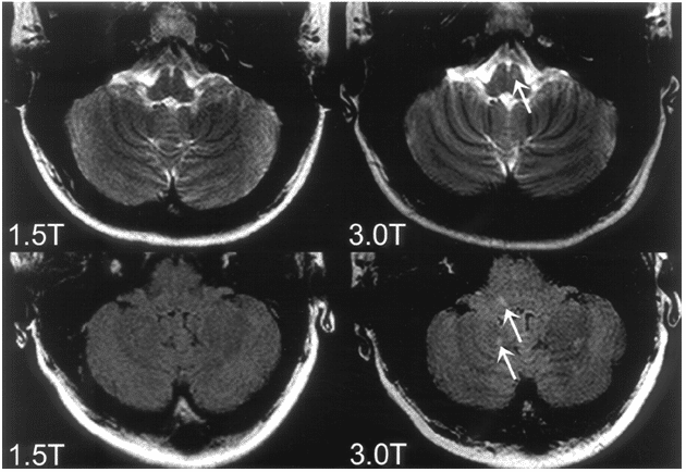 visual Comparison Of 3t And 15t Mri Amber Diagnostics